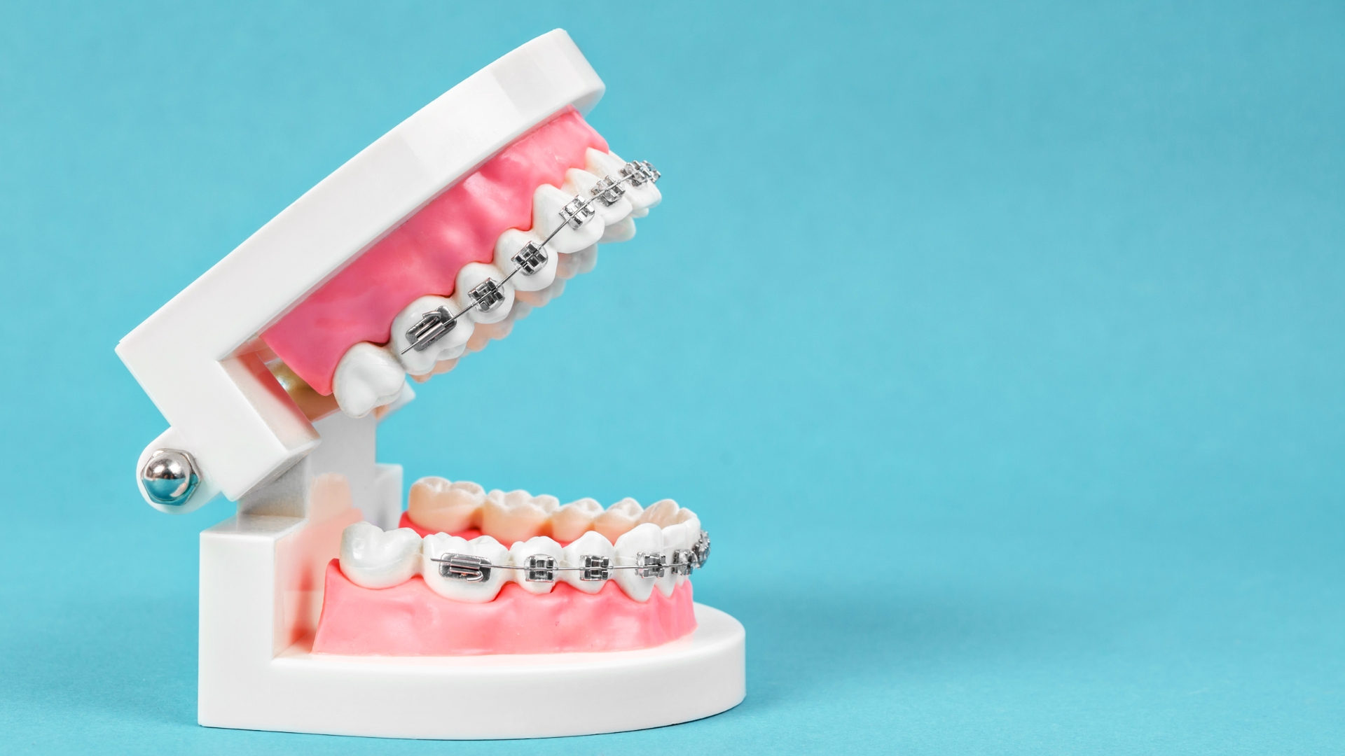 Contemporary Orthodontic Solutions: Advanced Materials and Treatment ...